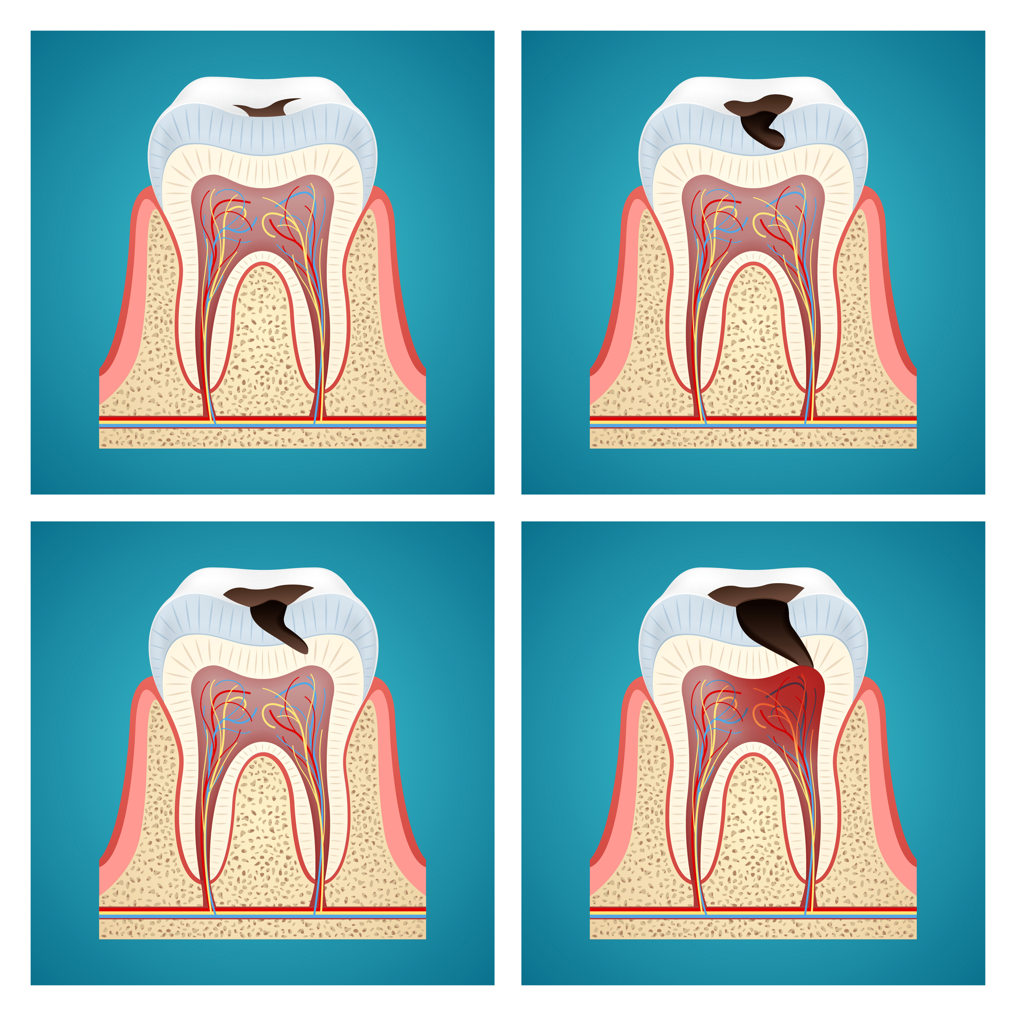 Know the Stages of Tooth Decay - Hoffman Dental Care